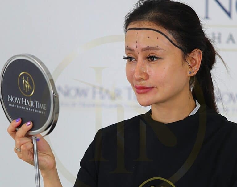 Hair Transplant For Women In Turkey 2023 Now Aesthetic