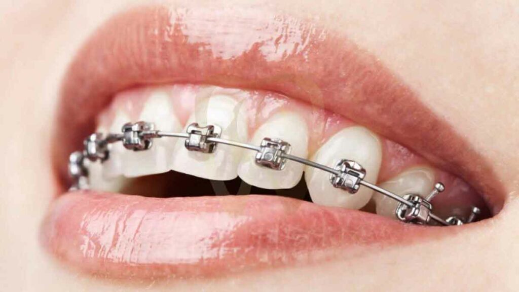Clip in Braces for Teeth: Everything You Need to Know - Now Aesthetic