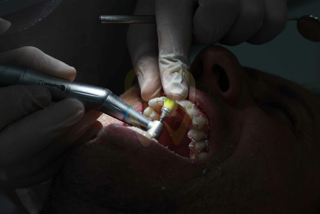 White Polish for Teeth: Achieve a Dazzling Smile - Now Aesthetic