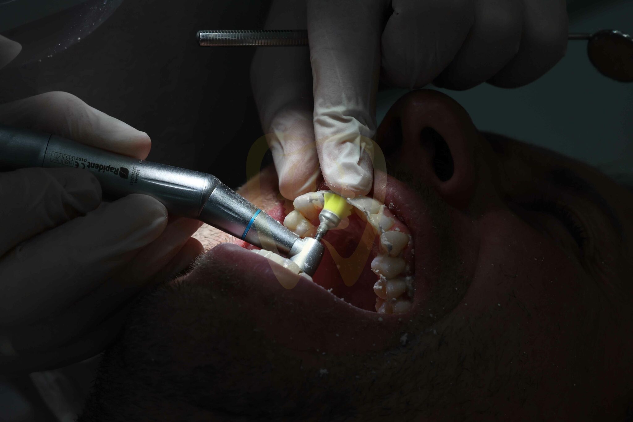 White Polish for Teeth: Achieve a Dazzling Smile - Now Aesthetic